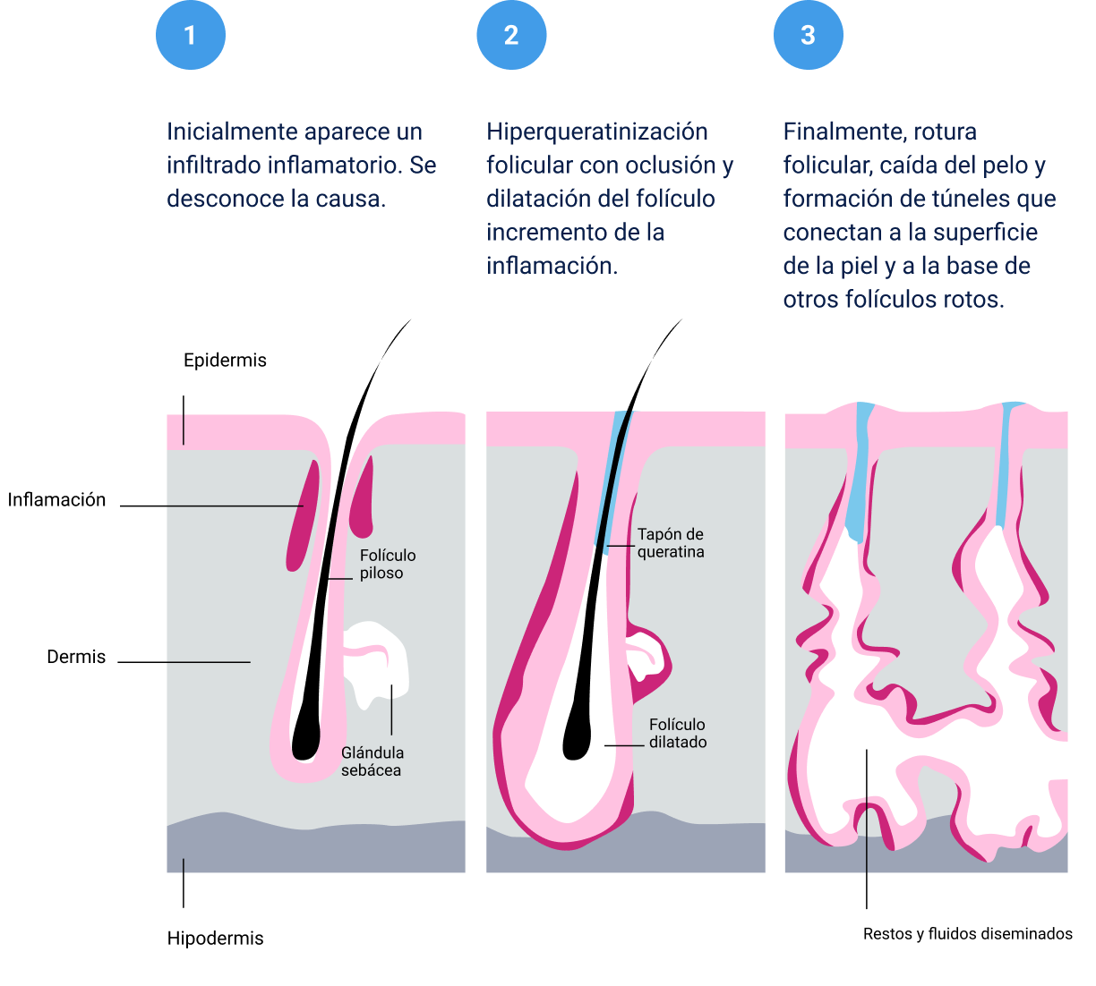 HS Hidradenitis supurativa