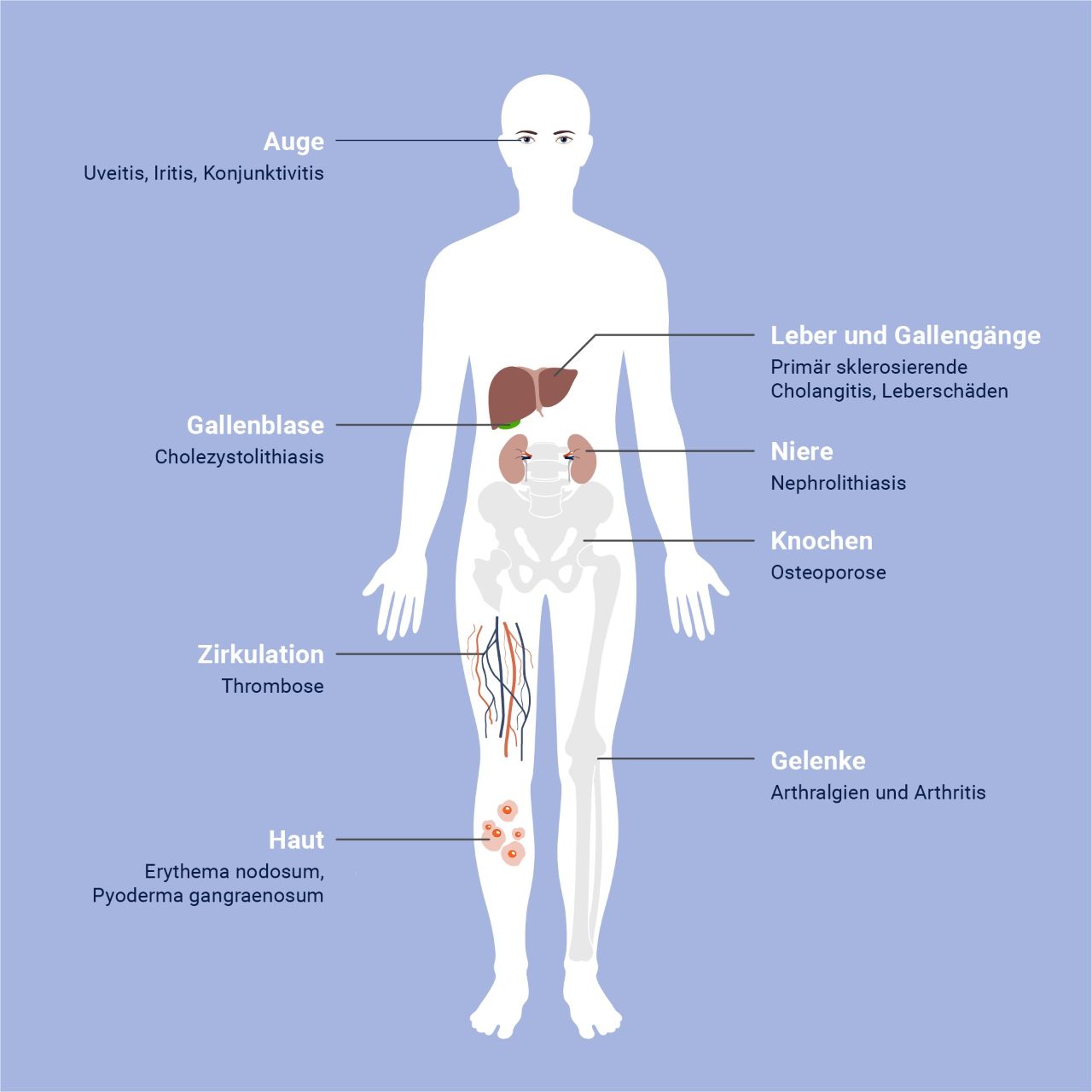 Colitis ulcerosa | AbbVie Pro Deutschland