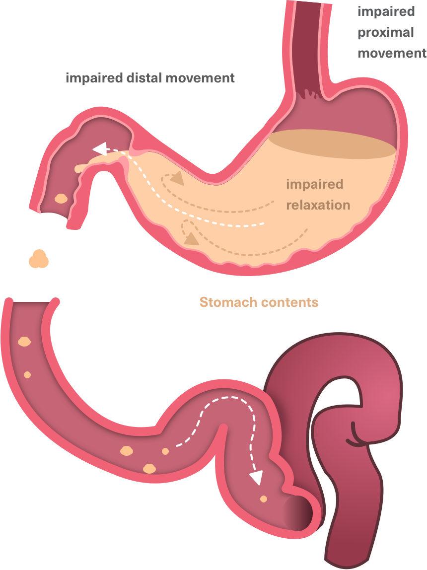 What is Complex/Advanced Parkinson's? | Duodopa® (levodopa/carbidopa ...